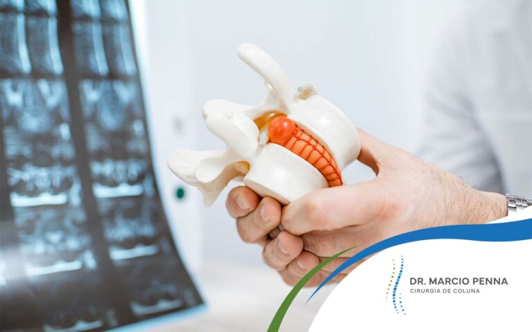 Hiperlordose lombar: quais as causas e opções de tratamento.